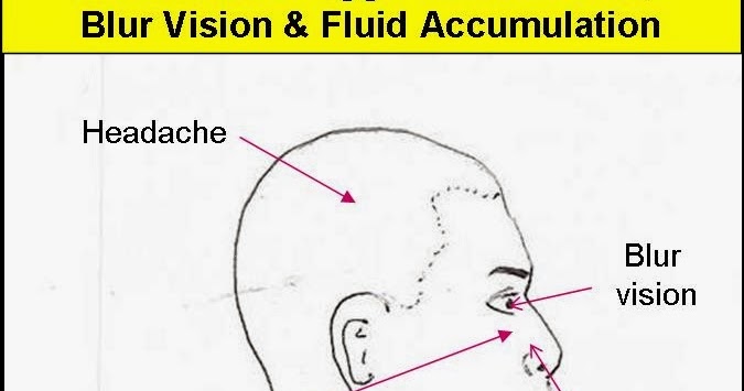 TCM News: TCM Block-Nose-triggered Headache, Blur Vision and Fluid ...