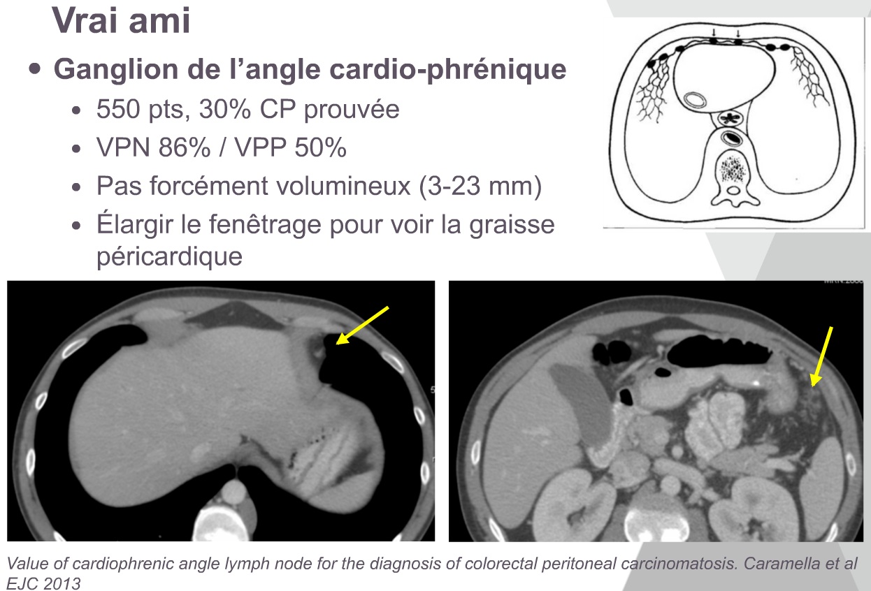 Ma bibliothèque en Imagerie Médicale: Carcinose péritonéale