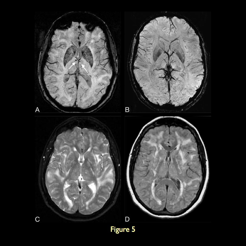 MRI BLOG: Susceptibility Weighted Imaging (II/II) - Image Gallery