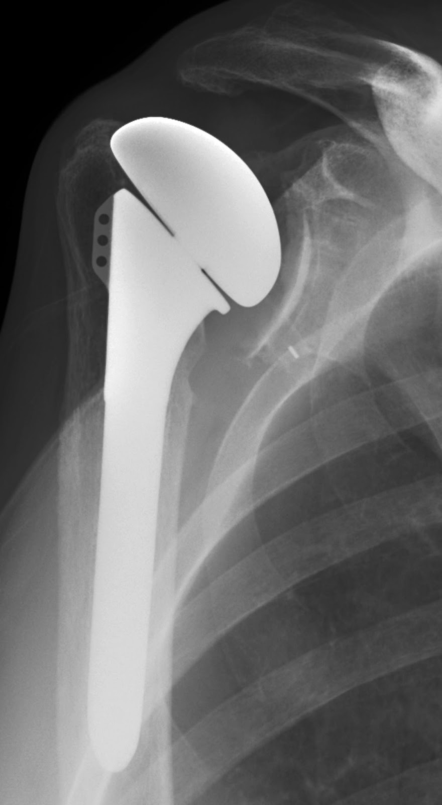 Shoulder Arthritis / Rotator Cuff Tears / Shoulder Pain : Shoulder ...