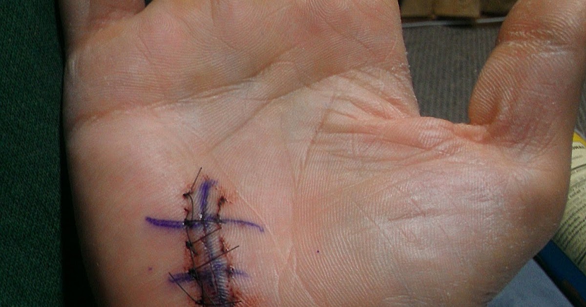 Rock Climbing with a Hamate Hook Fracture: October 2nd, 2012 - Surgery