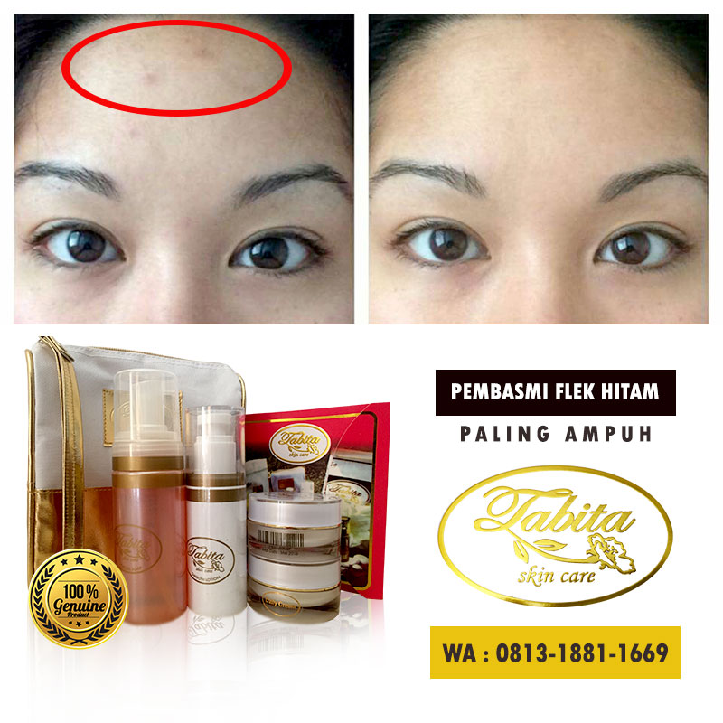 Cara Menghilangkan Flek Hitam Yang Ampuh Pakai Skin Care | Tabita Skin Care