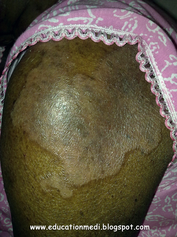 Psoriatic Arthritis Affecting Knee Joint Photos Medical Education