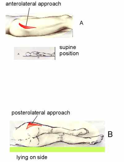 Tom's Physiotherapy Blog: Surgery to the Hip