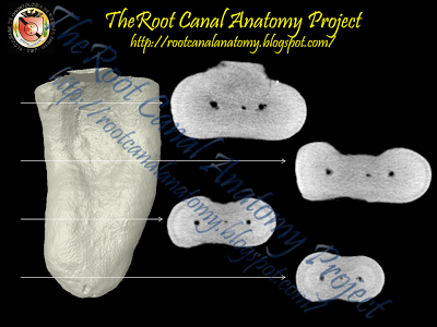 The Root Canal Anatomy Project: Middle Mesial Canal: Mandibular First Molar