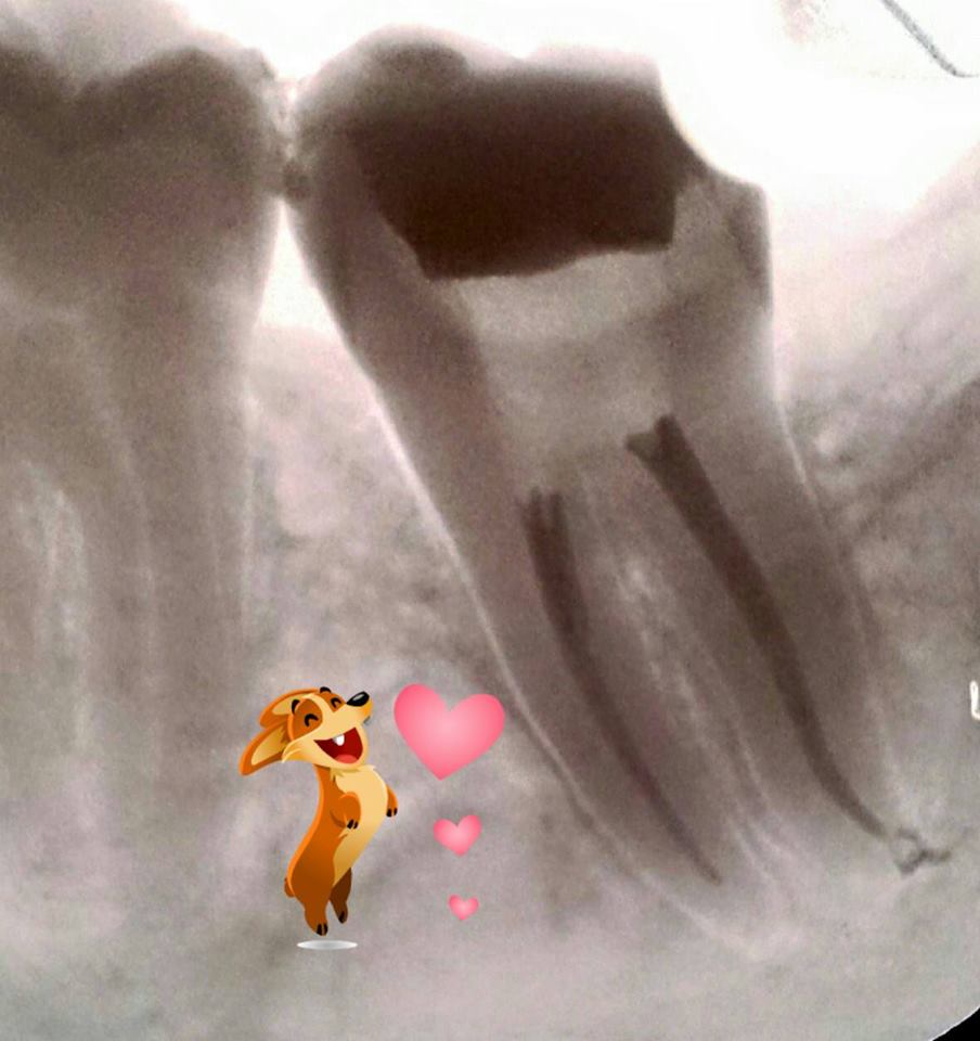 Descobrindo e explorando a Endodontia : Periodontite Apical Primária ...