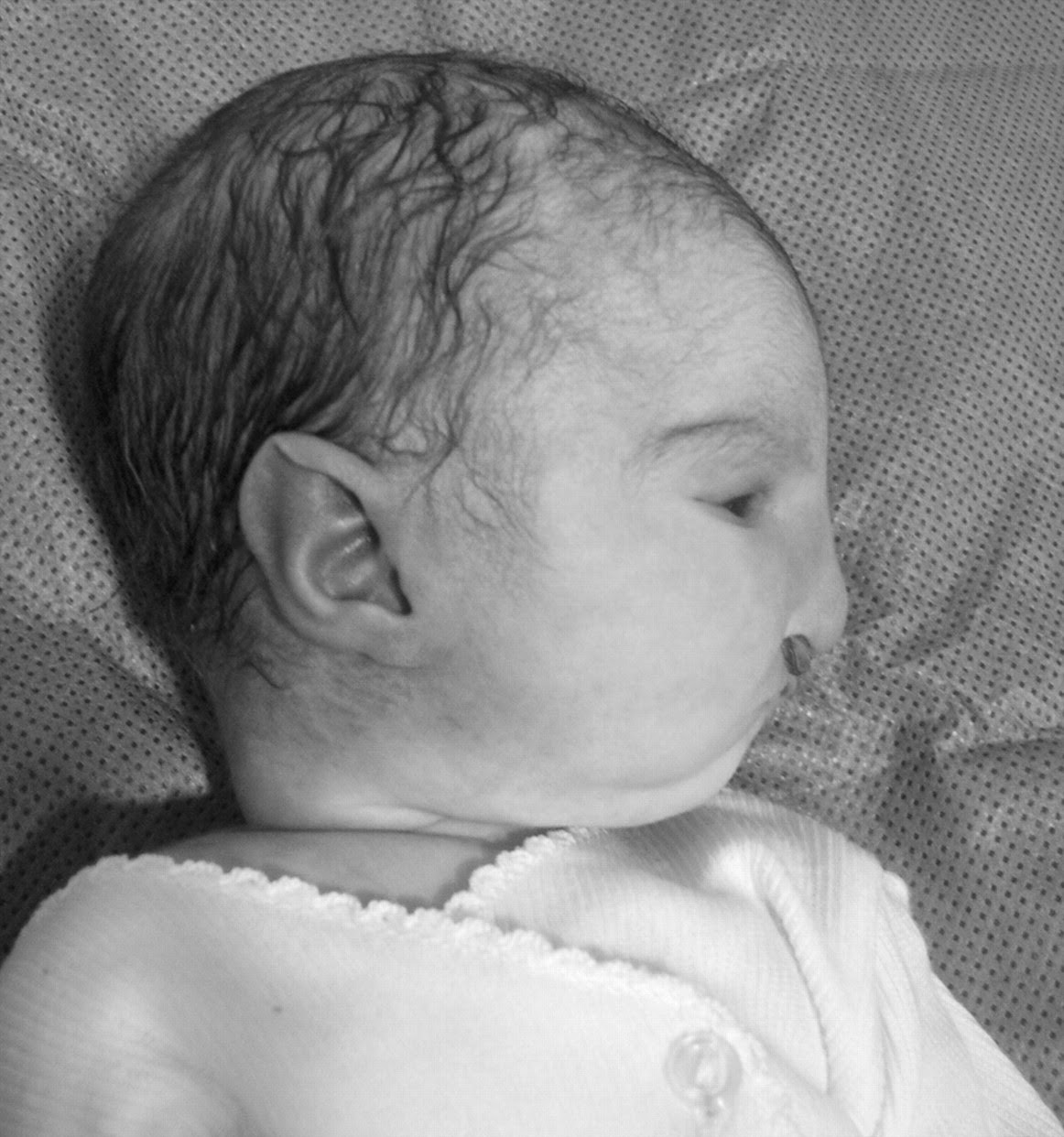 NurseTecmilenio: Genetic mutations: Wolf-Hirschhorn syndrome