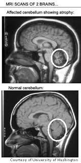 Medical Treatment Pictures-for Better Understanding: Machado-Joseph Disease