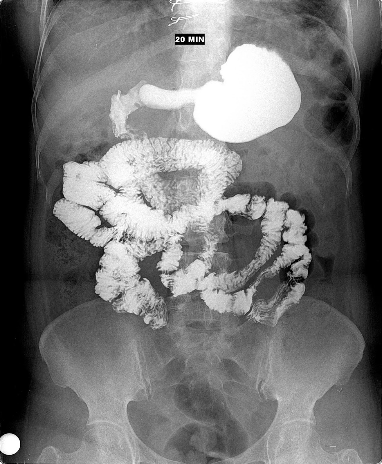 Trânsito Intestinal