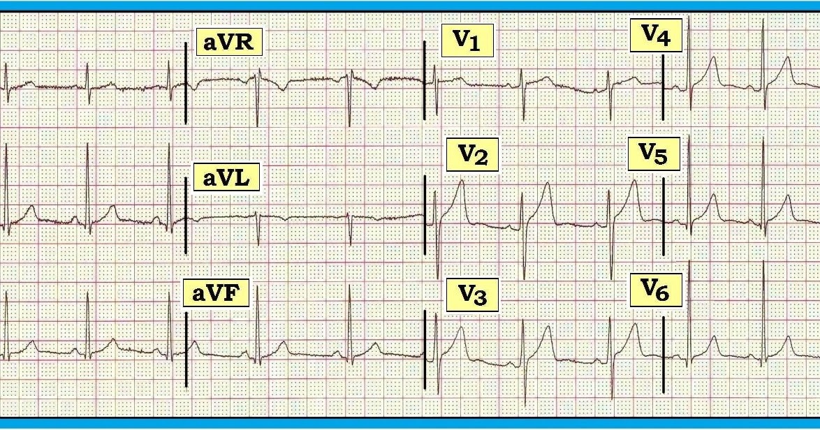ECG Interpretation: ECG Interpretation Review #47 (Normal Variants ...