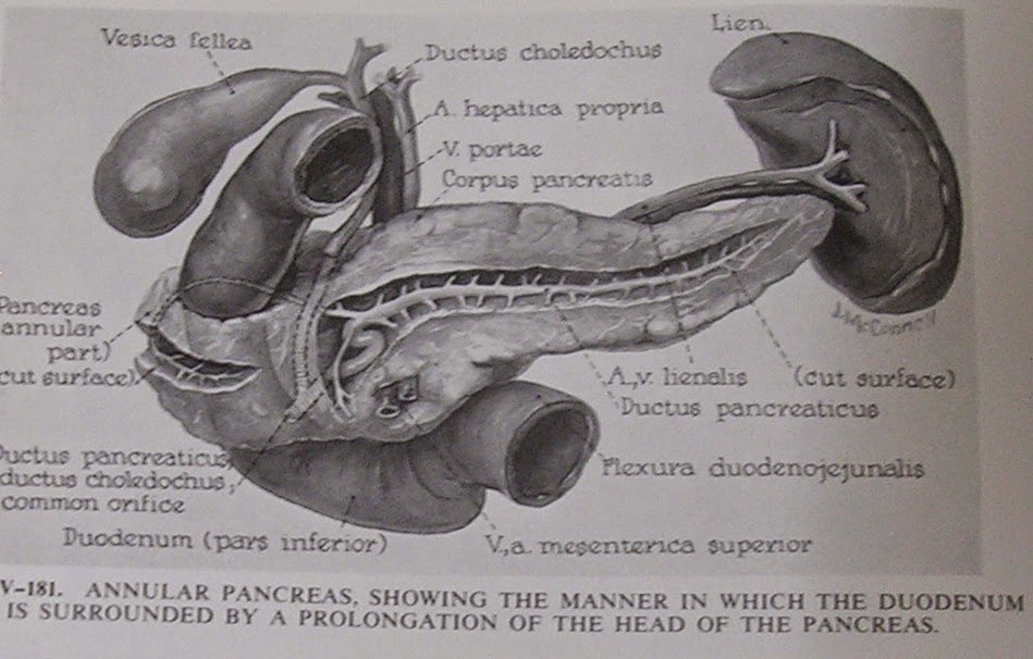 Chaaria Mission Hospital - Kenya: Annular pancreas