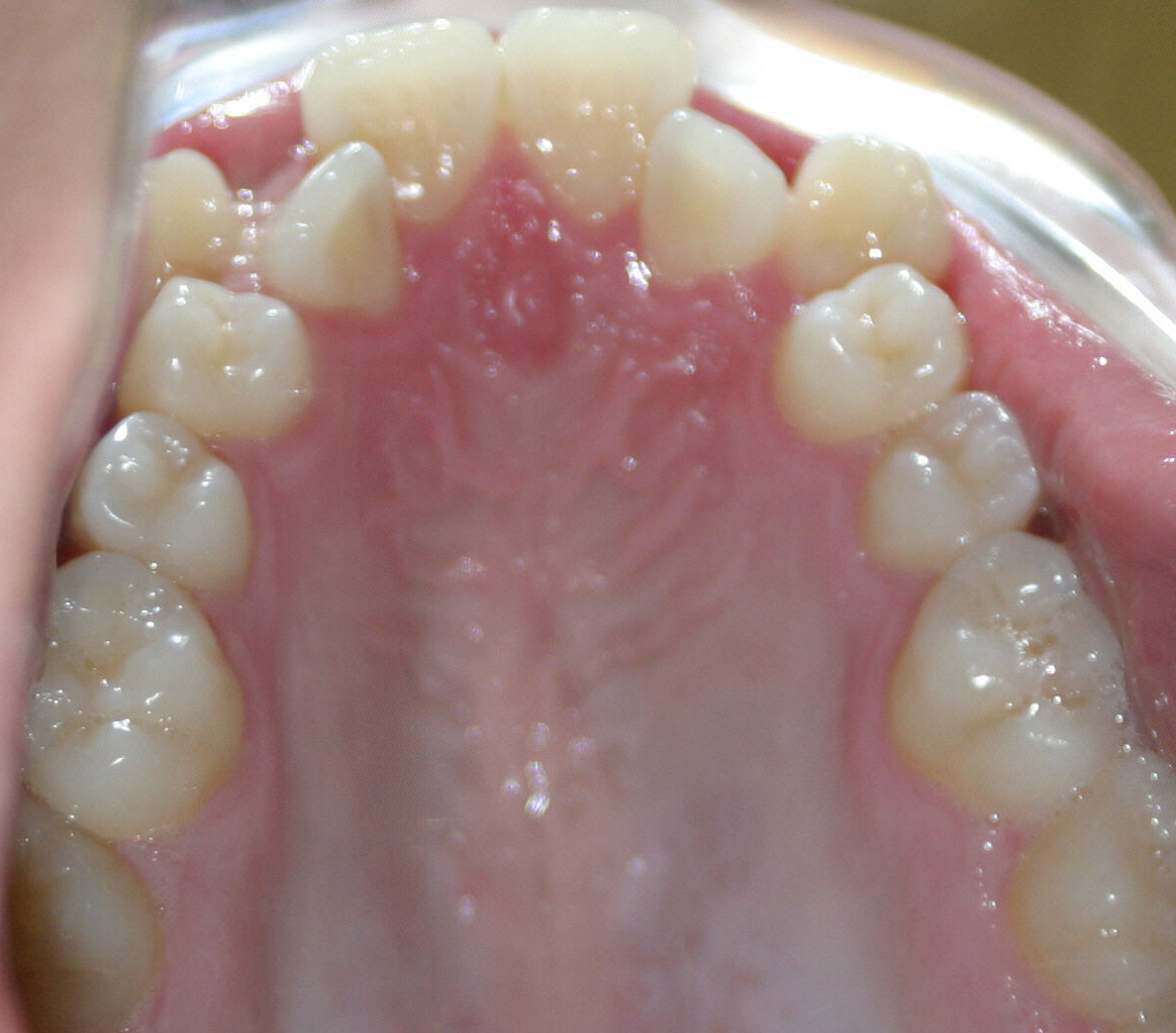 James R. Waters, DDS, MSD, PA: Crowded teeth can lead to early tooth loss.