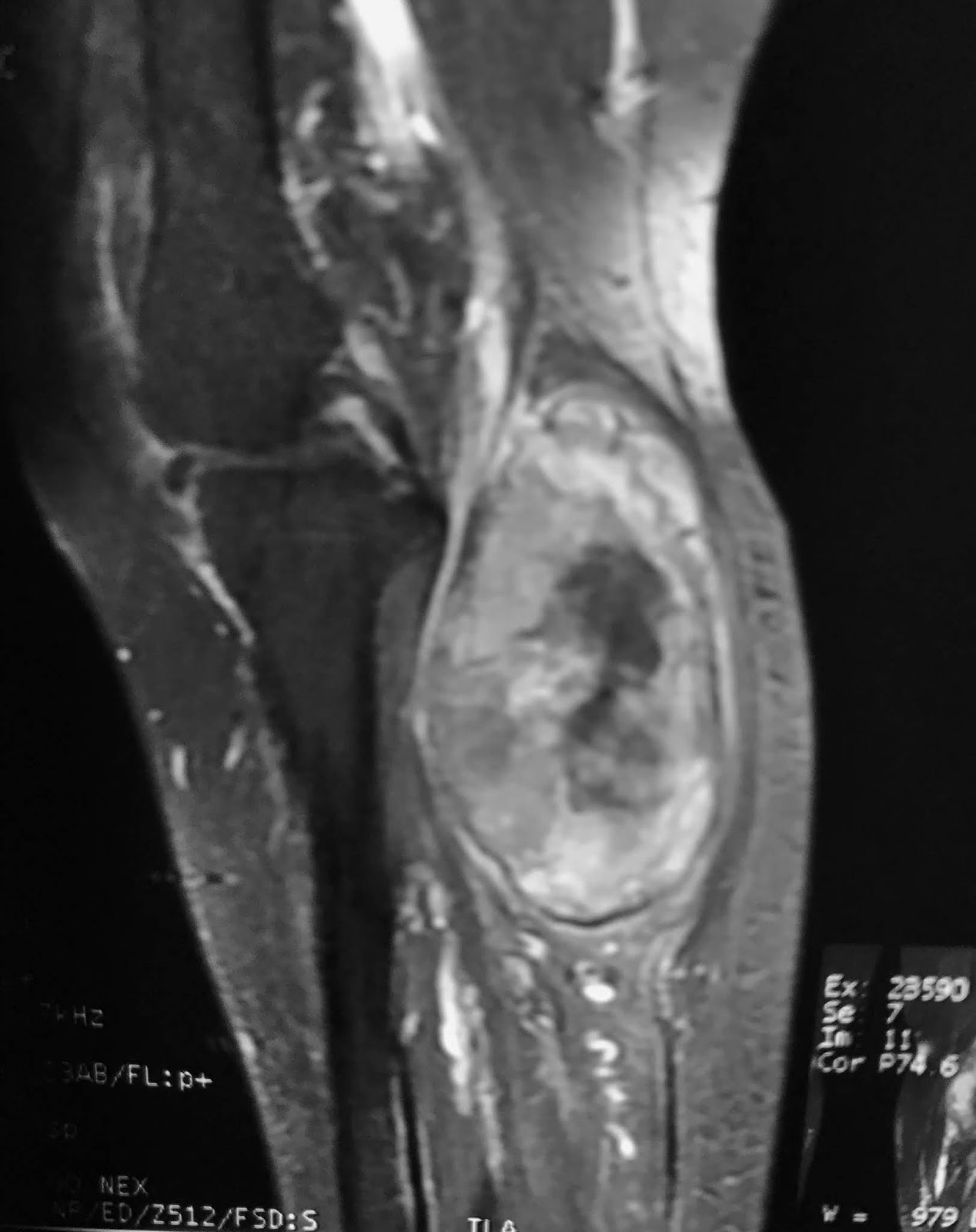 VIETNAMESE MEDIC ULTRASOUND: CASE 523: FIBULAR BONE TUMOR, Dr PHAN ...