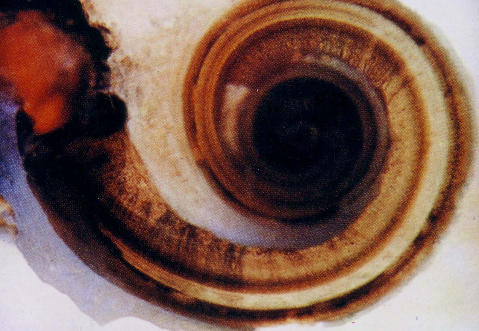 Sensorineural Hearing Loss