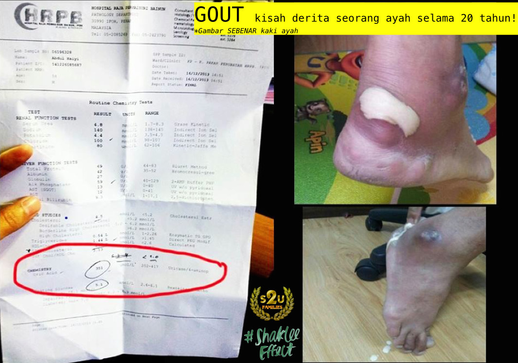 Testimoni Omega Guard dan Alfafa : Bacaan GOUT Ayah Kini NORMAL