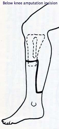 health blog: AMPUTATION SURGERY AND AMPUTATION