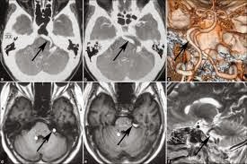 Medical Treatment Pictures-for Better Understanding: Microvascular ...
