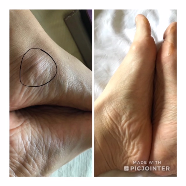 Running Solutions: Accessory Navicular Bone