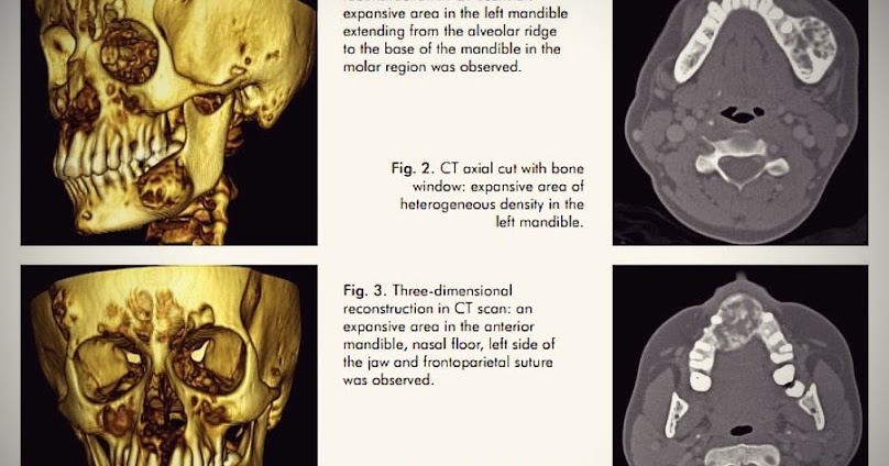 PDF: Facial lesions caused by renal osteodystrophy in a patient with ...