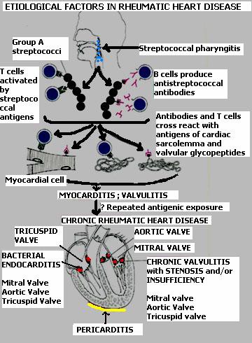 Penyakit Jantung Reumatik dan Demam Reumatik ~ Informasi Kedokteran Dan ...