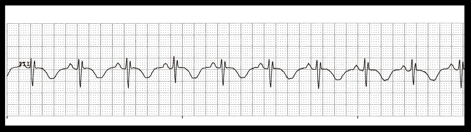 Practice EKG Strips 323