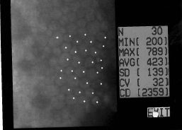 IOA Madrid : CÓRNEA GUTTATA. DISTROFIA ENDOTELIAL DE FUCHS