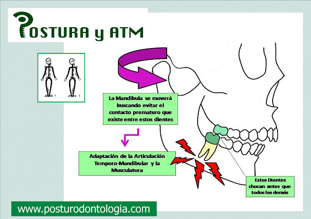 Postura y ATM: Tiene Problemas de ATM? Disfunción de la Articulación ...