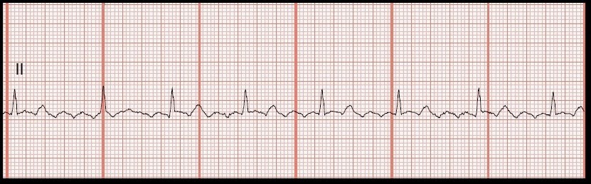Practice Rhythm Strips 238