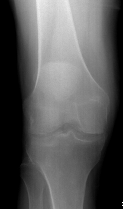 Calcification of Articular Cartilage - Sumer's Radiology Blog