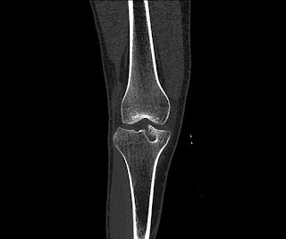 CT Knee - Radiology Imaging