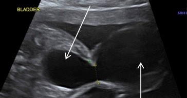 Urogenital Tract Abnormalities - SONOVISION ULTRASOUND