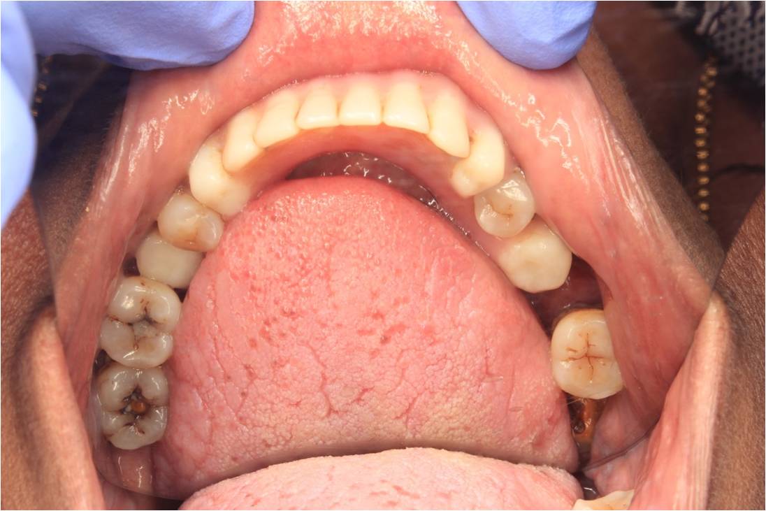 Best dental clinic chennai: FULL MOUTH REHABILITATION WITH BASAL ...