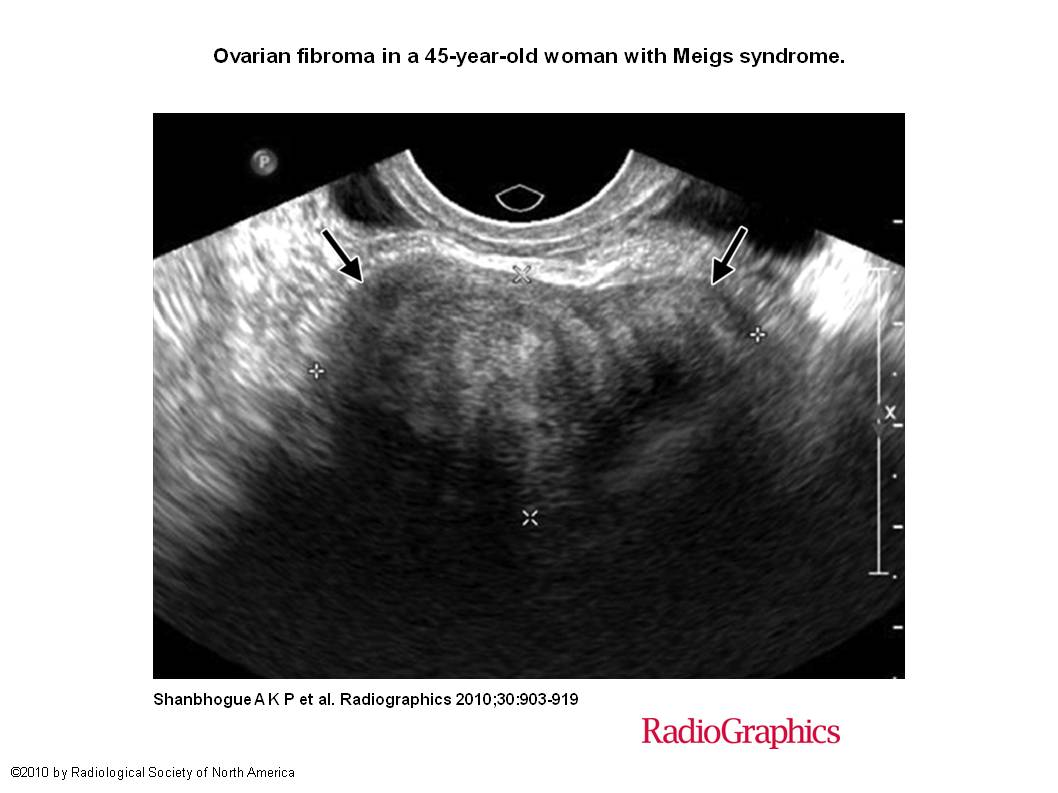 BÀI SOẠN VỀ SIÊU ÂM CHẨN ĐOÁN: Demons-Meigs syndrome