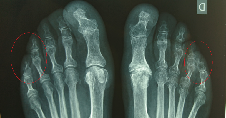 Podología Bethy: Heloma Interdigital