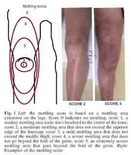 SAÚDE DO ADULTO: Monitorização não invasiva da perfusão periférica