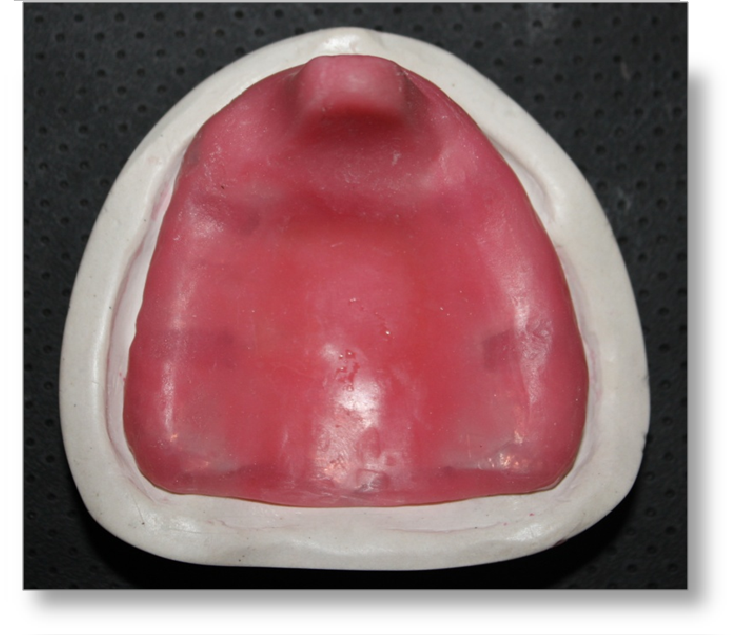 Understanding Prosthodontics - Tagore Dental College & Hospital-By ...