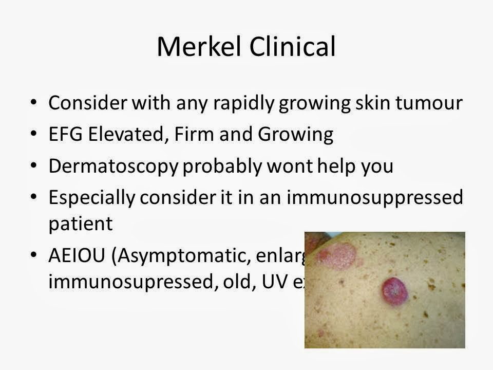 Dermpath Made Simple - Neoplastic: Merkel Cell Carcinoma