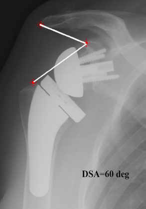 UW Shoulder and Elbow Academy: What is the optimal position of a ...