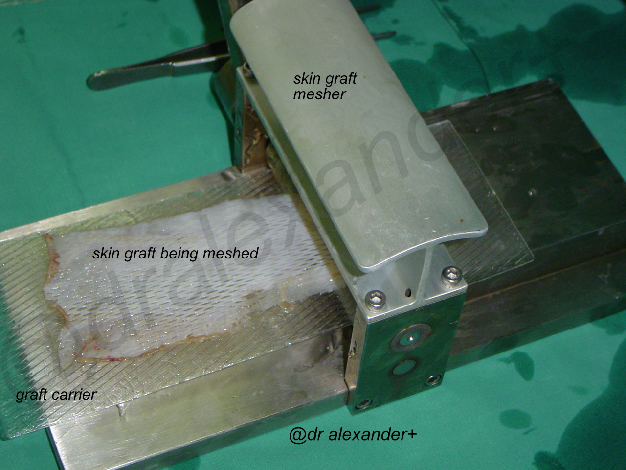 Cosmetic-Plastic Surgeon: Skin graft, grafting, Humby knife, Aesculap ...