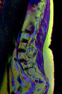 Nevit's blog: Color MRI of spine
