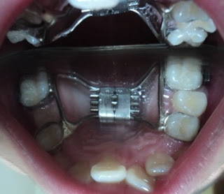 ODONTO-ESTOMATOLOGICA: APARATO DISYUNTOR HIRAX