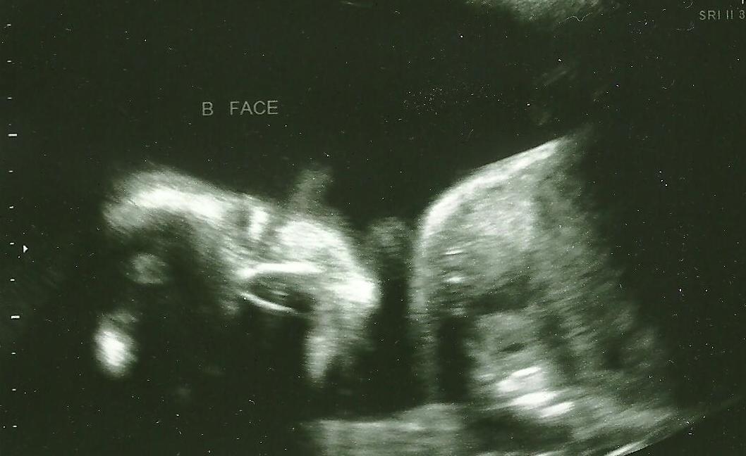 2 New Rubys: 31 Weeks: Growth Scan + MFM appt