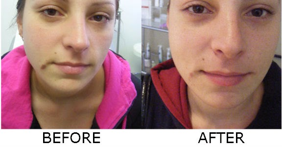 Moles | Health and Beauty Tips