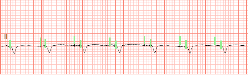 Basic EKG Rhythm Test 38