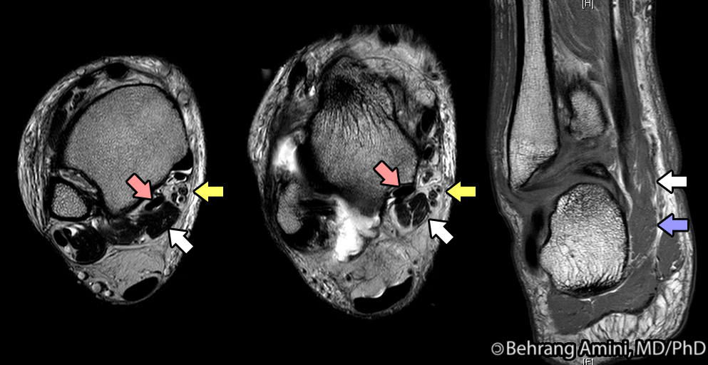 Roentgen Ray Reader: Flexor Digitorum Accessorius Longus Muscle