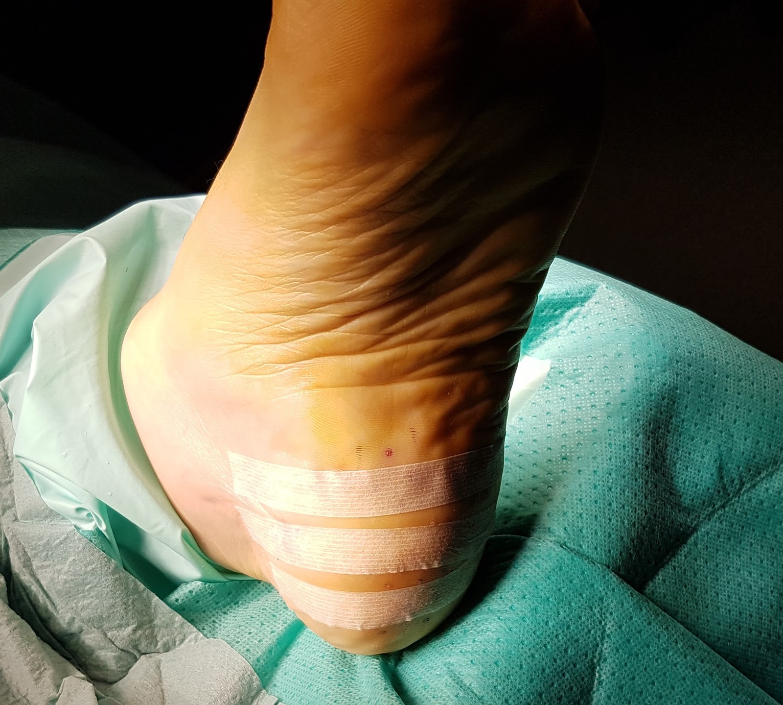 Podo Basas al Día: Fascitis plantar con Topaz. Espolón calcáneo. Rotura ...