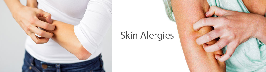 WHAT IS SKIN ALLERGY?