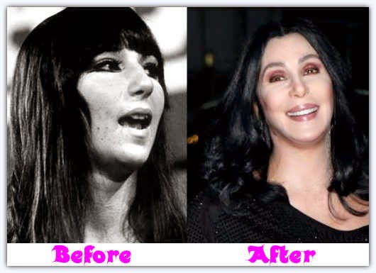 Cher Plastic Surgery Before and After Nose Job, Breast Implants Pictures
