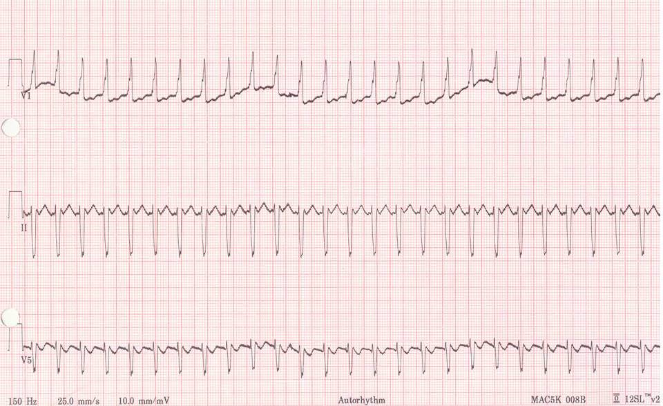 Pedi cardiology: Narrow complex tachycardia - Re-entry type