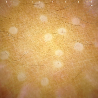 VIRTUAL GRAND ROUNDS IN DERMATOLOGY 2.0: Lichen Nitidus